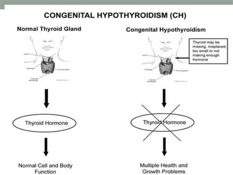 Congenital Hypothyroidism Cretinism Flashcards Quizlet