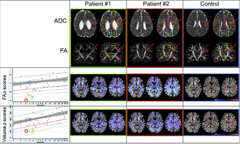 Demonstration Of Automated Abnormality Detection Using The Atlas