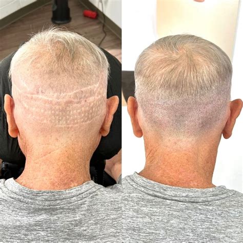 Hair Transplant Scar Camouflage Fue And Fut Scalp Micro Usa