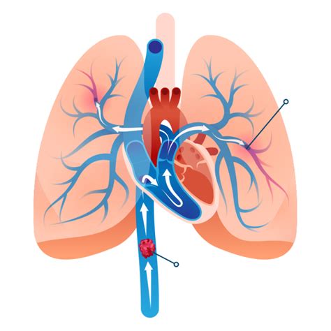 Steckbrief Thrombose Angehörige Pflegen