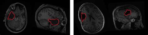 Figure 1 From A Deep Learning Framework To Localize The Epileptogenic