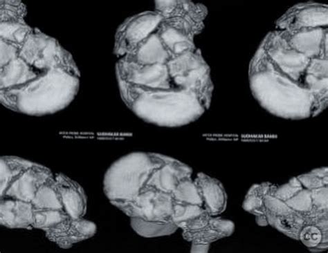 Comminuted Lateral Tibial Plateau Fracture