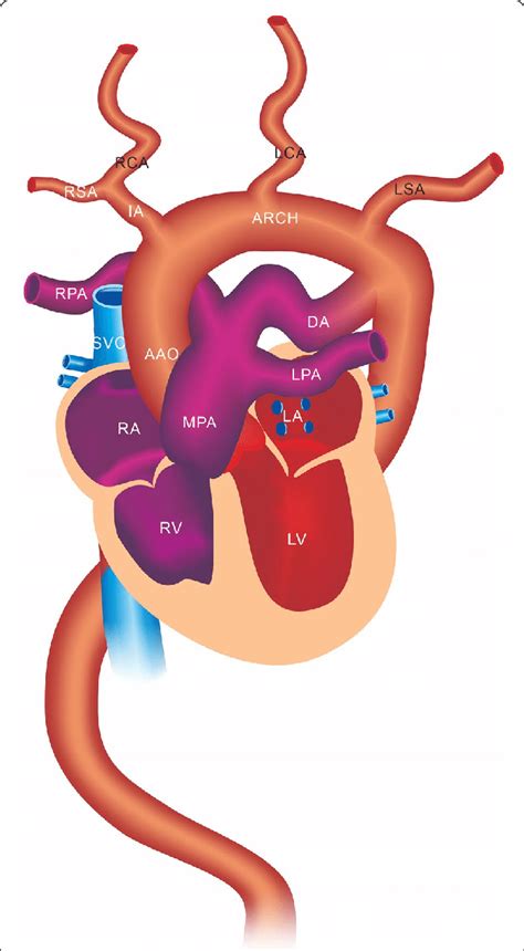 The Model Diagrams Of Arterial Tortuosity Syndrome Reveals Elongation