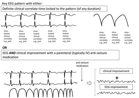 Is This An Eeg Seizure Concept Eeg Activity That May Cause Neuronal