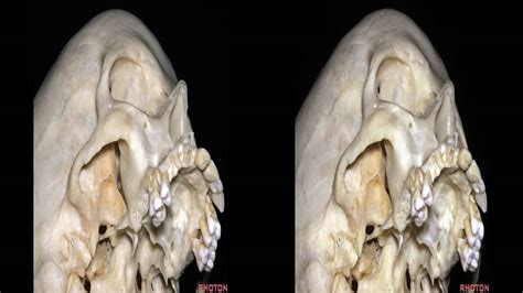Orbitozygomatic Approaches 3d Tv Youtube