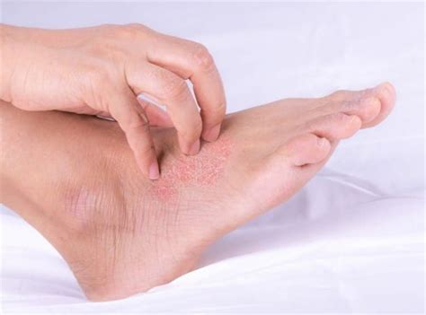 Psoriasis en las uñas piel y articulaciones de los pies Consejos para