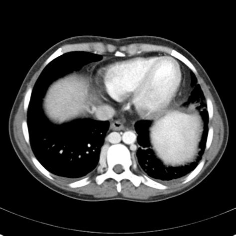 Biliary Necrosis Liver Transplant Radiopaedia 21876 21846 B Nc