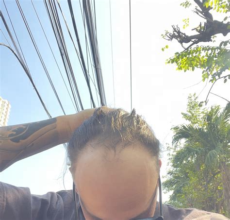 Progress Update 6 Weeks Post Operation With Dr Laorwong 3650 Fue R