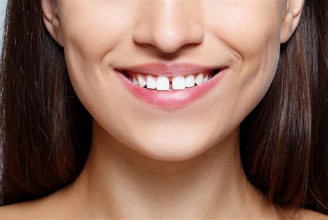 How To Reduce Gap Between Teeth Naturally At Home Bestcheck