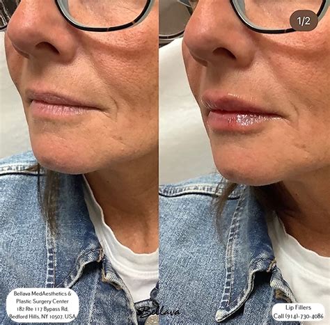 Is 2 Syringes Of Lip Filler Right For You