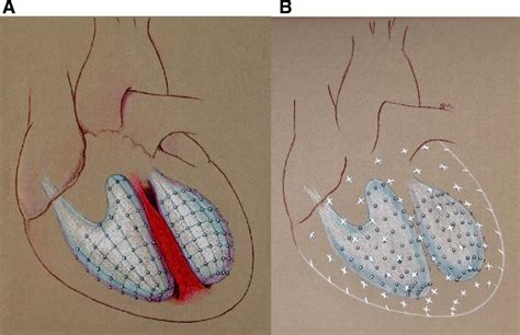 Electrode Arrays Used During Intraoperative Mapping A Right