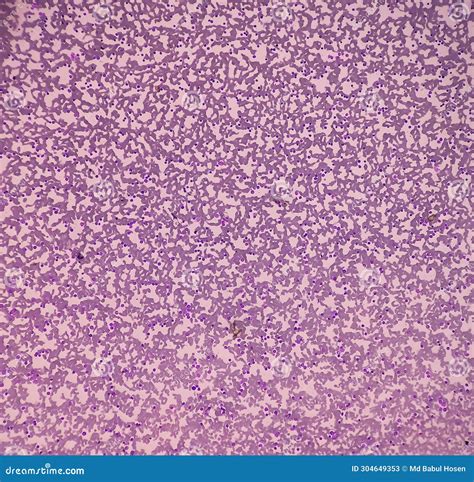 Leukemia Blood Cells Blast Cells And Immature Leukocytic Cells In