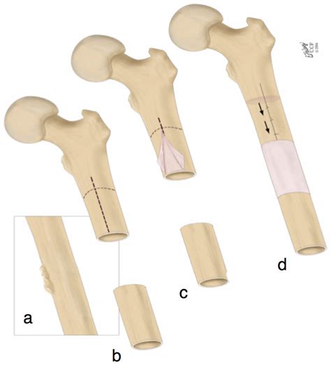 The One Stage Bone Transport Procedure 20 22 Harnesses The