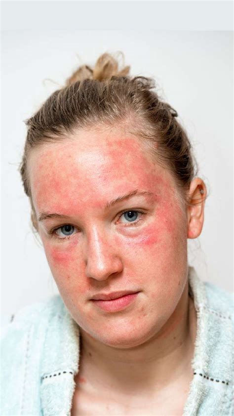 5 Natural Home Remedies For Skin Allergies You Must Try