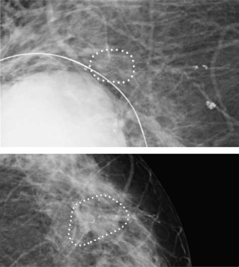 Predictors Of Mammographic Microcalcifications Pmc