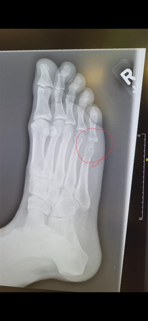 5th Metatarsal Fracture At The Neck R Brokenbones