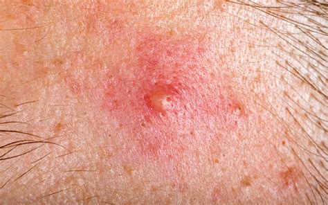 How To Treat Nodular Acne With Ayurvedic Remedies Vedix