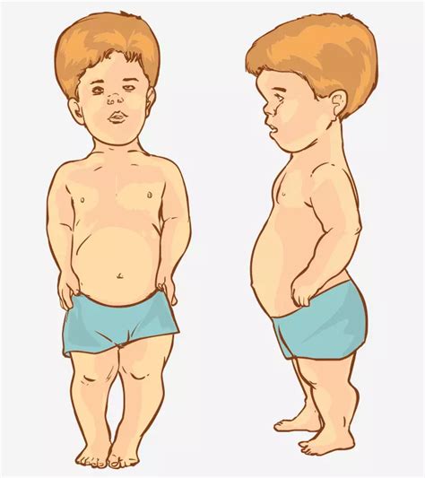 Dwarfism Types First Global Standards To Help Diagnose And Manage Most
