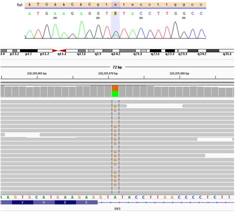 Chromatogram From Direct Sequencing By The Sanger Method Showing Des