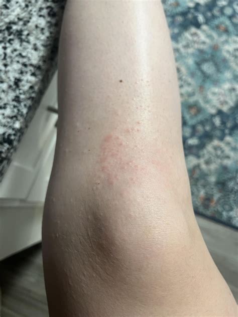 Rash On Knees After Vacation Rdermatologyquestions