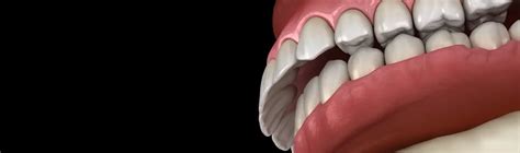 What Is A Deep Bite And How To Treat It Dentakay