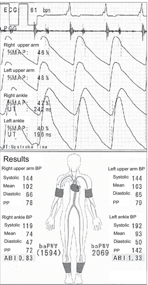 Ankle Brachial Index Explained At Olivia Icely Blog
