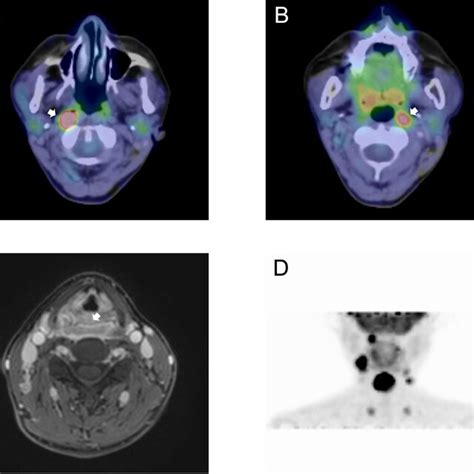 Hypopharyngeal Carcinoma With Bilateral Retropharyngeal Lymph Node