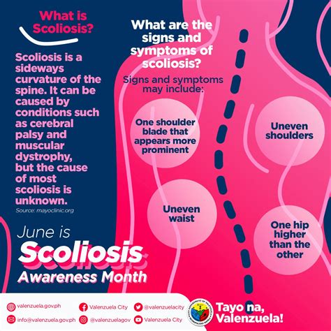 Valenzuela City June Is Scoliosis Awareness Month To