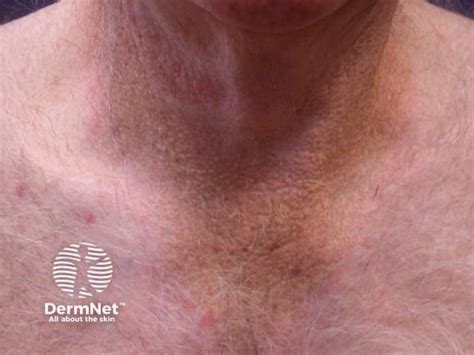 Elastosis Image