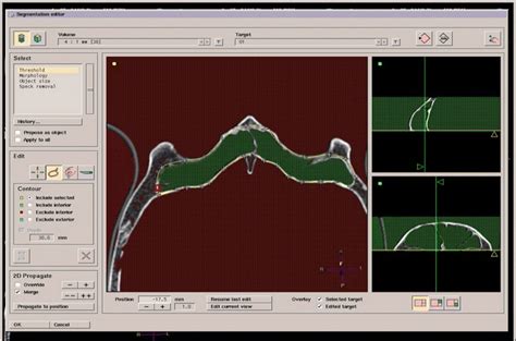 Frontal Sinus Segmentation And Volumetric Measurement Procedure On Ct