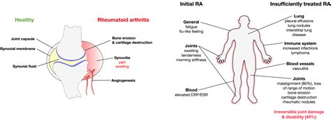 Rheumatoid Arthritis Encyclopedia Mdpi