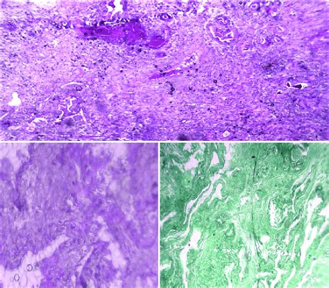 Biopsy Of The Polyp From The Right Uncinate Process Showing