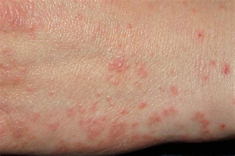 What Is Scabies