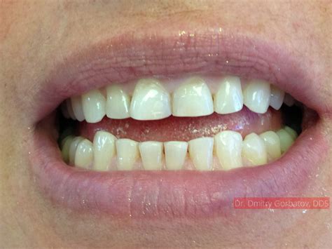 Cosmetic Tooth Reshaping Gorbatov Dentistry Your Dentist In