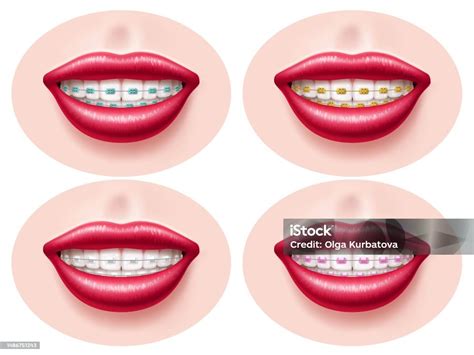 현실적인 치아 치과 교정기 웃는 입술 교정 교합 교정 조임 구조 다양한 유형의 금속 세라믹 및 사파이어 건강 및 미용 Utter