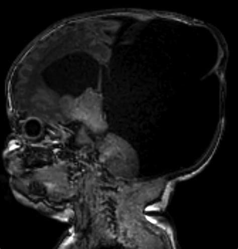 Repair Of An Occipital Meningocele And Scalp Soft Tissue Rec