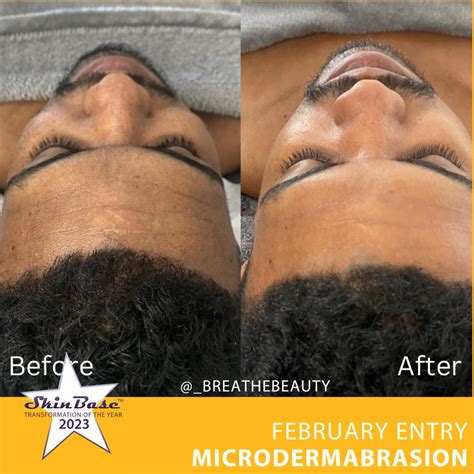 10 Microdermabrasion Benefits