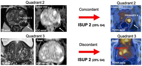 Prostate‐specific Membrane Antigen Positron Emission Tomography In