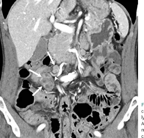 Figure 1 From Nomenclature And Lymphatic Drainage Patterns Of Abdominal Lymph Nodes Semantic