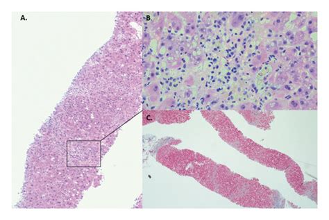 A Liver Biopsy Hande X40 Showing Bridging Necrosis And Collapse Of