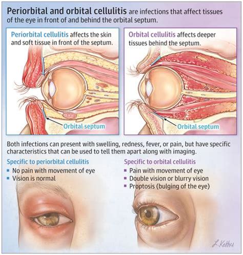 Periorbital And Orbital Cellulitisjama X Mol
