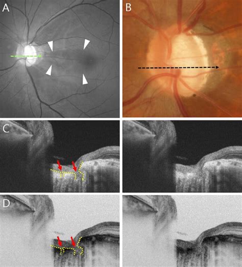 Representative Case Of Lamina Cribrosa Defect Lcd Associated With