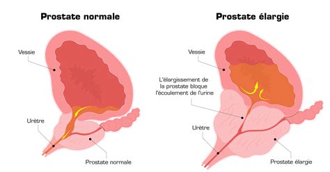 Chirurgie de l hyperplasie bénigne de la prostate HBP EMS Urology