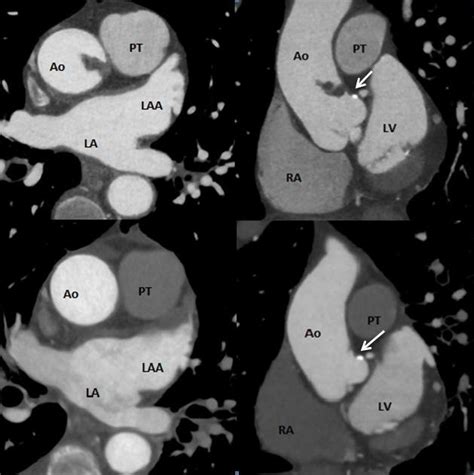 Initial Top And 3 Month Follow Up Bottom Ct Angiography Showing Download Scientific Diagram