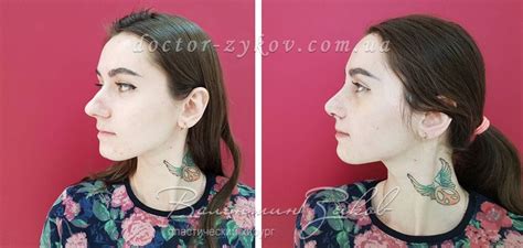 Rhinoplasty Before And After Gallery DR ZYKOV Warsaw Poland