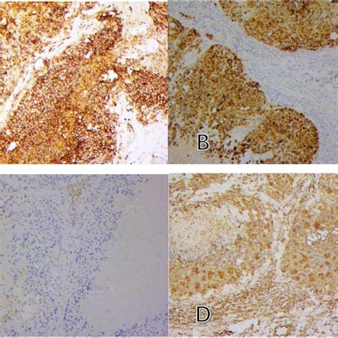 Microscopic Findings Of The Right Axillary Lymph Nodes Hande Staining