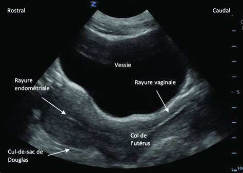 Image échographique De Lutérus En Axe Long La Sonde Est Dirigée