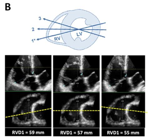 Assessment And Function Of The Rv Ppt Echo 155 Flashcards Quizlet