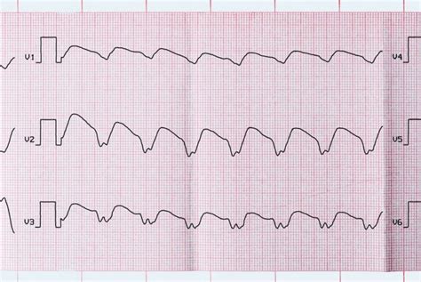 The Types Of Tachycardia Health And Detox And Vitamins