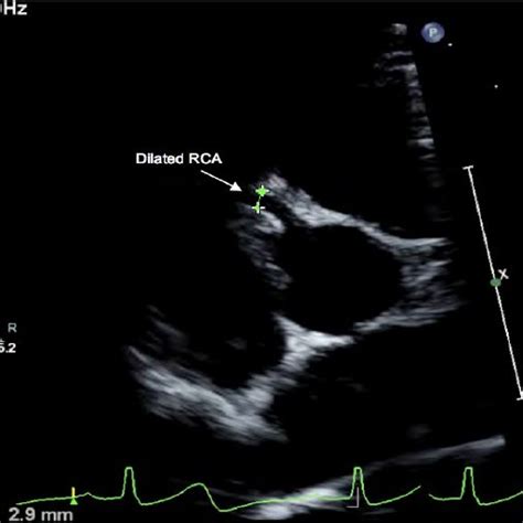 Parasternal Short Axis Echocardiographic Image At The Level Of The